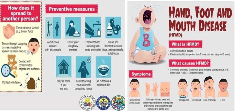 101 HFMD cases in Bacolod